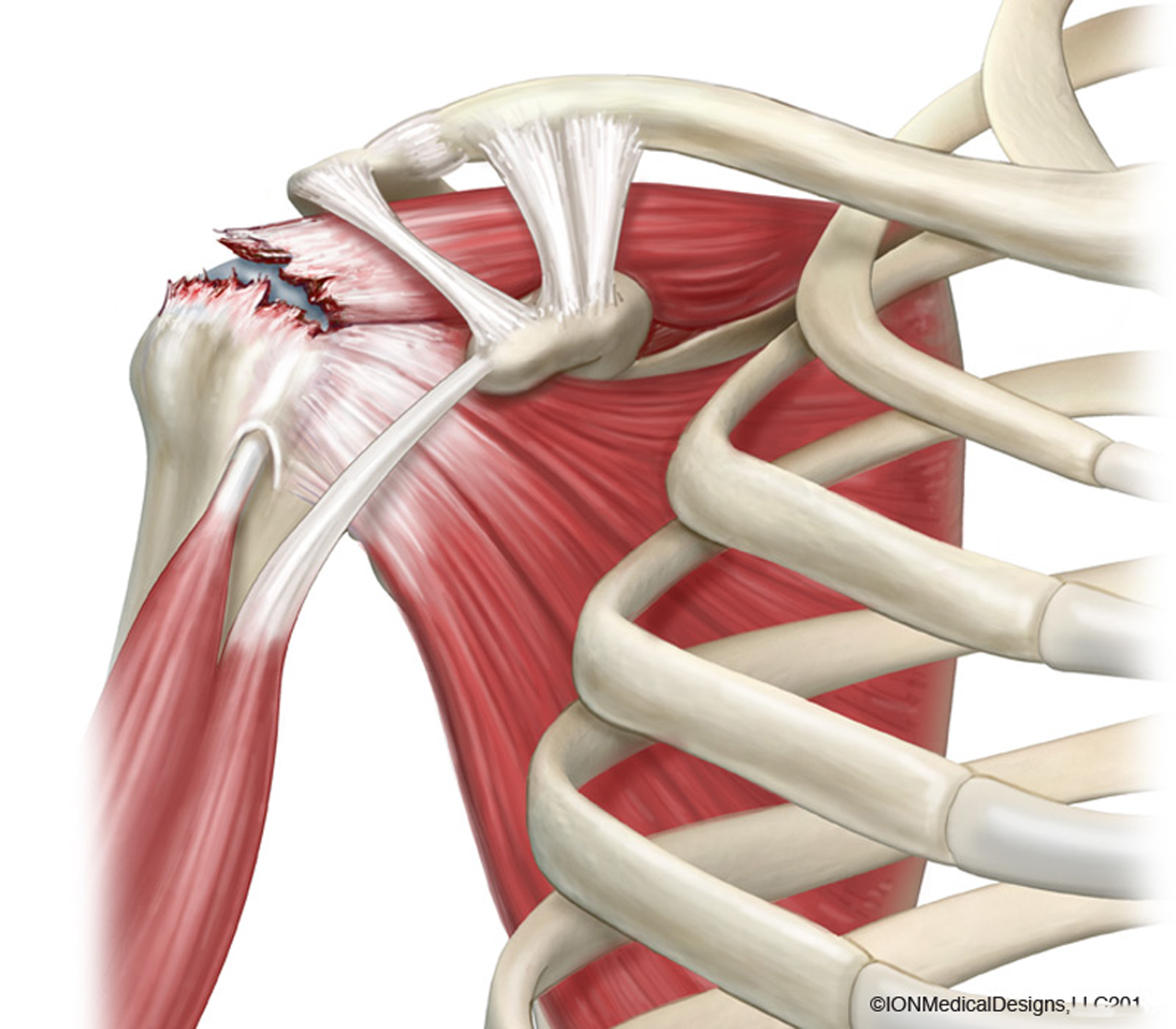 Innovation Rotator Cuff Surgery Just Got Easier 5280